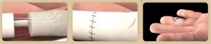 Reparación tendón flexor con supramid - Nuevas técnicas traumatológicas